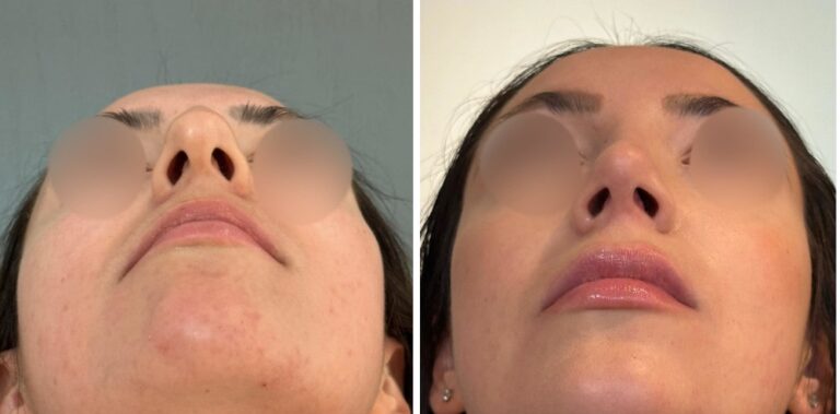 Nostril Reduction Surgery: Correcting Nasal Flaring