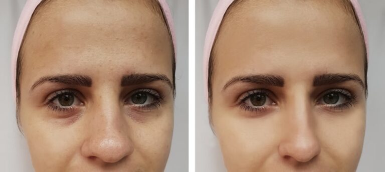 How Should Your Nose Bridge Stand?