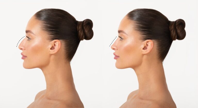 How Should Your Nose Bridge Stand?