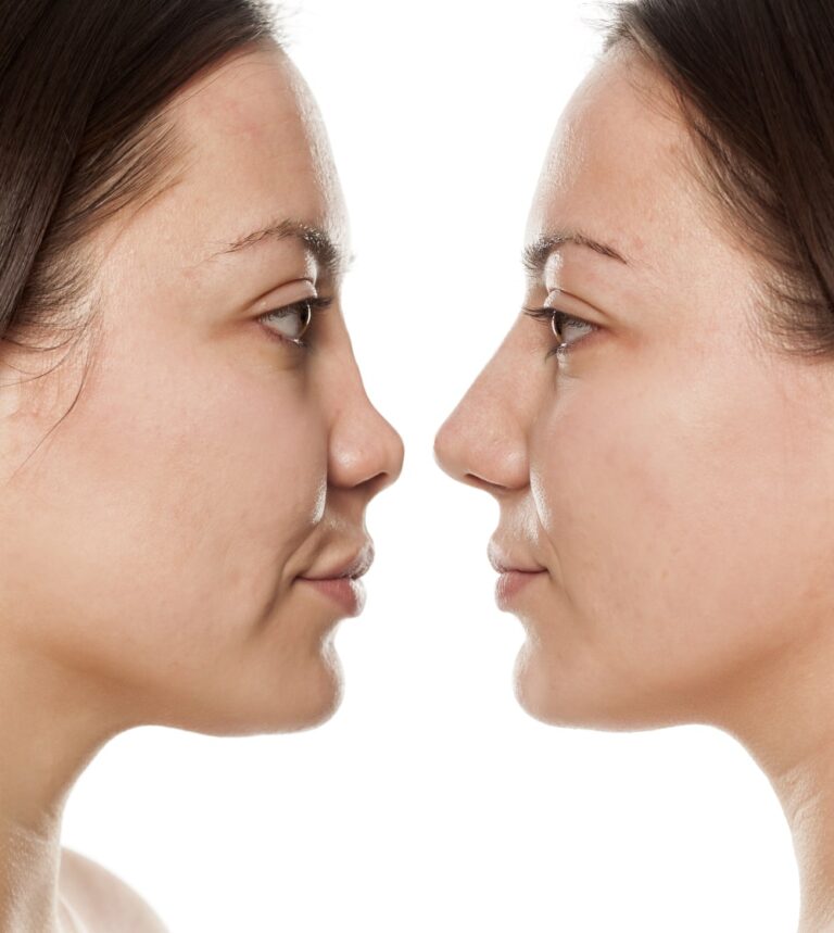 How Should Your Nose Bridge Stand?