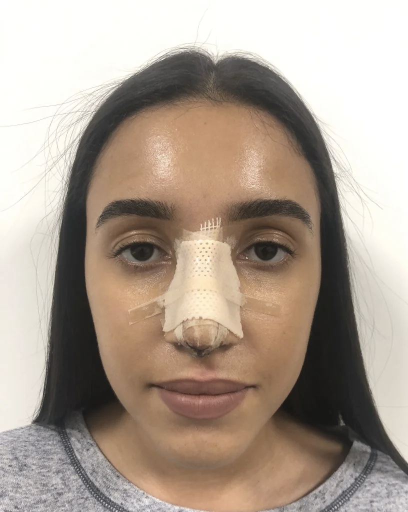 Rhinoplasty Recovery Timeline: Your Guide to Healing After a Nose Job